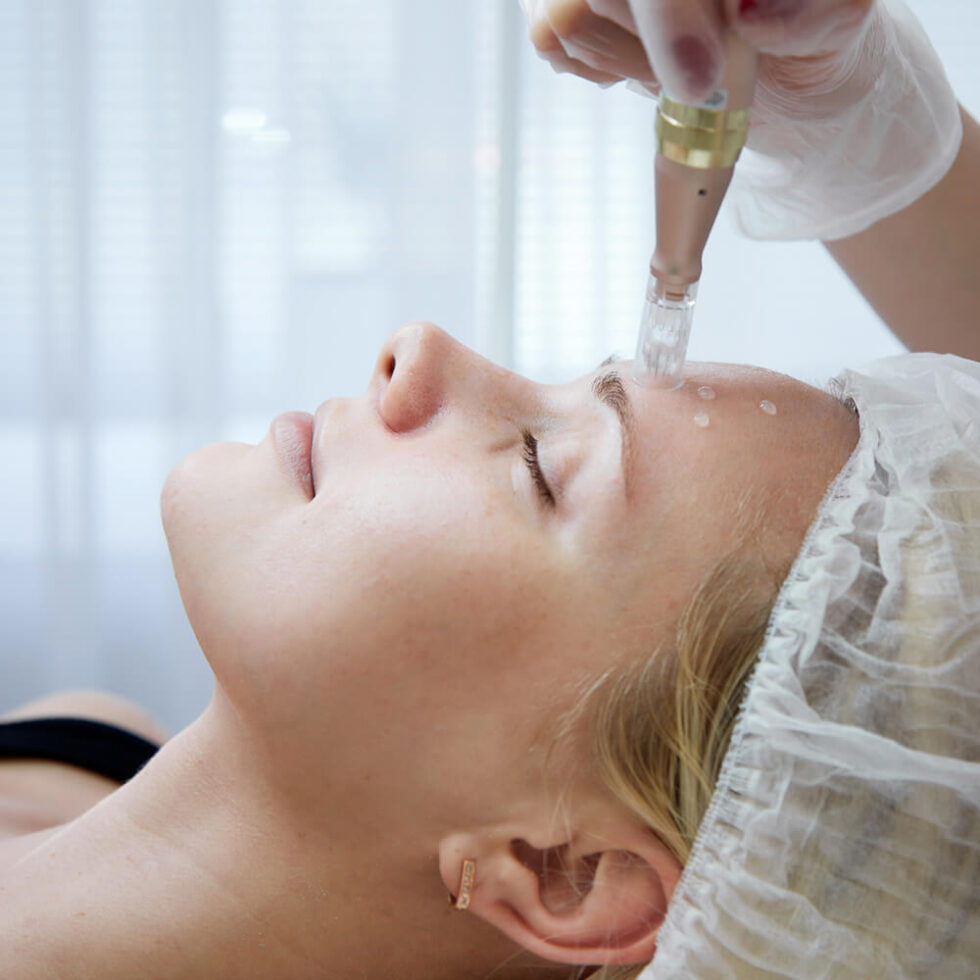 Dermapen Behandeling - Titula Kliniek